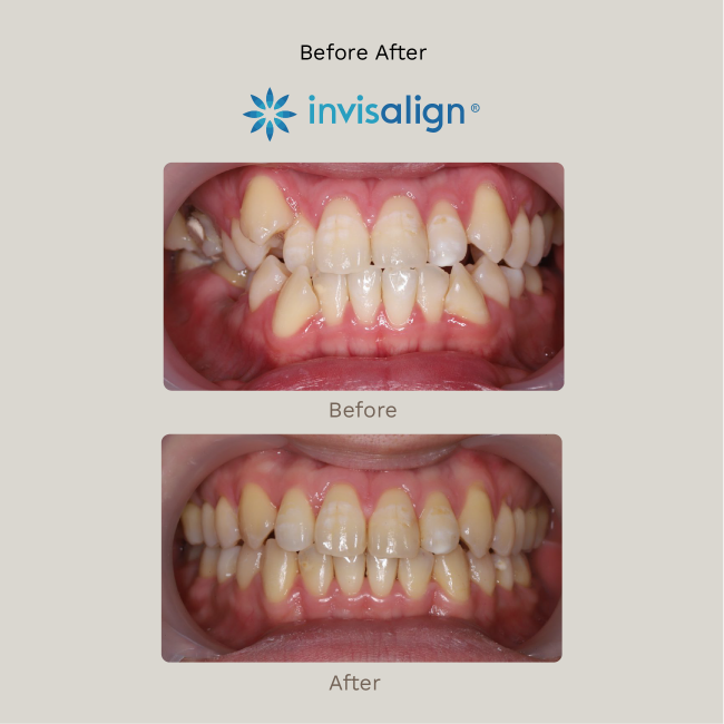 First Digital Dentistry in Lampung!